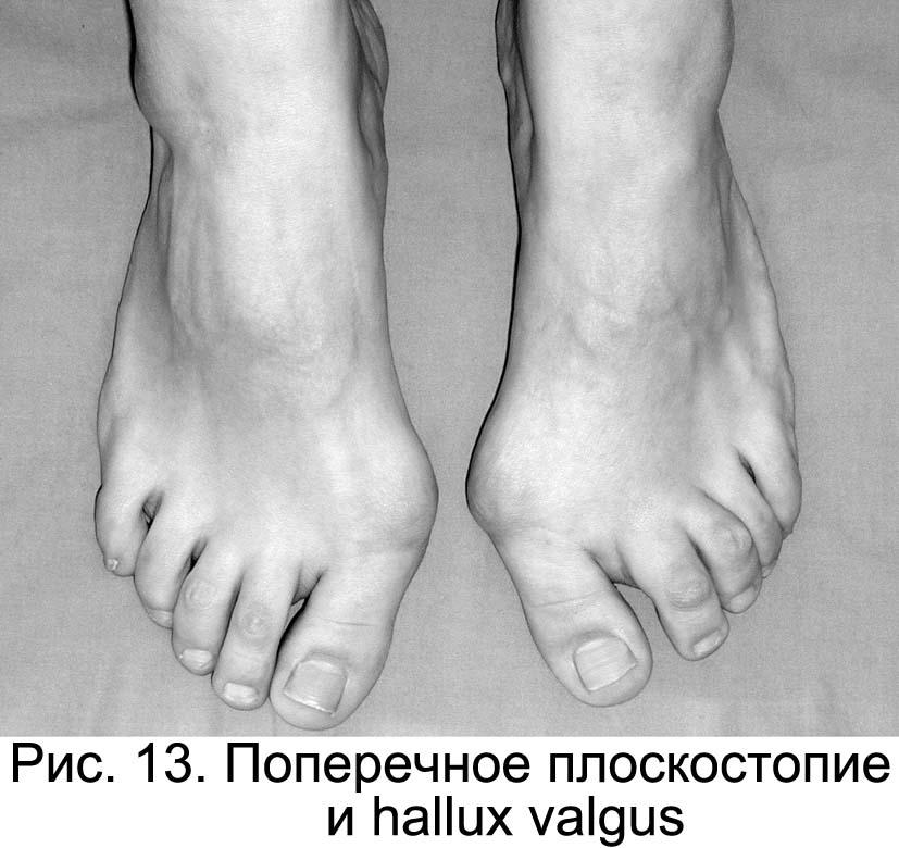 Поперечное плоскостопие и деформации пальцев