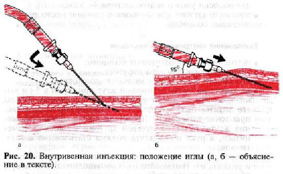 Техника внутривенного капельного введения
